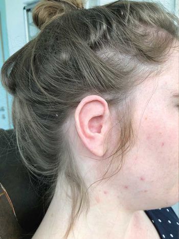 Wie entsteht eine Epithese